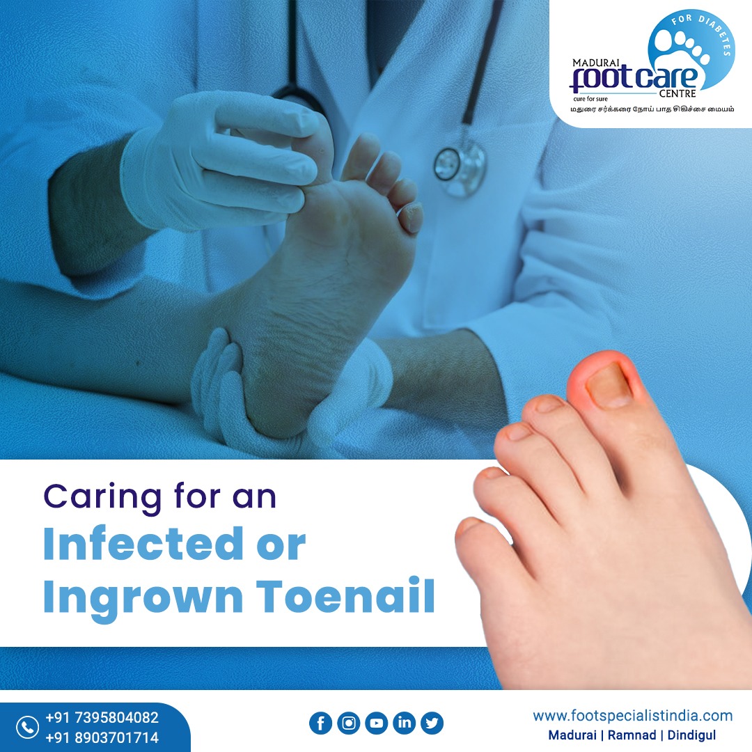 Ingrown Toenail Infection: Prevention and Treatment Tips